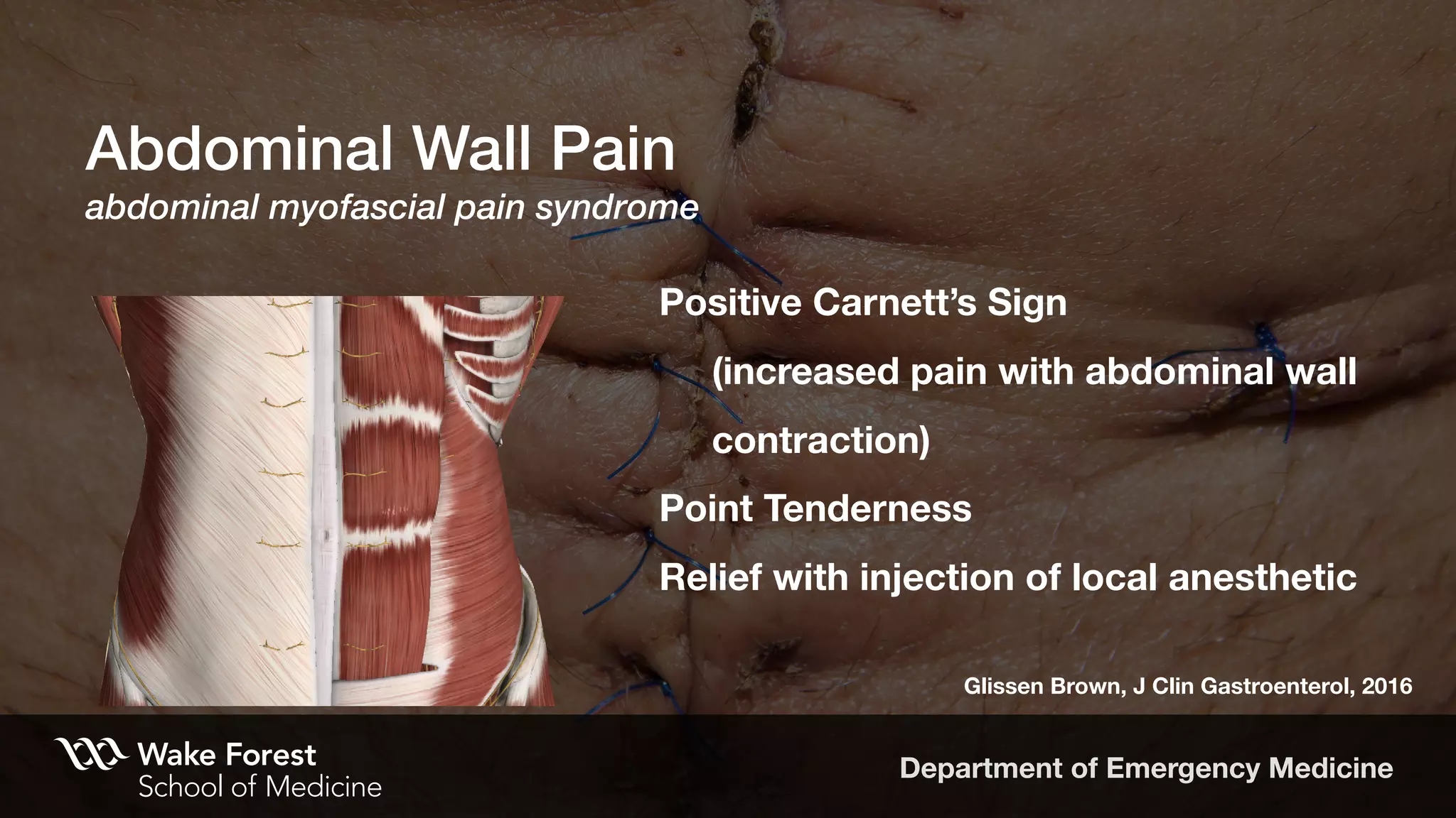 Chronic Abdominal Pain for the ED Provider | PDF