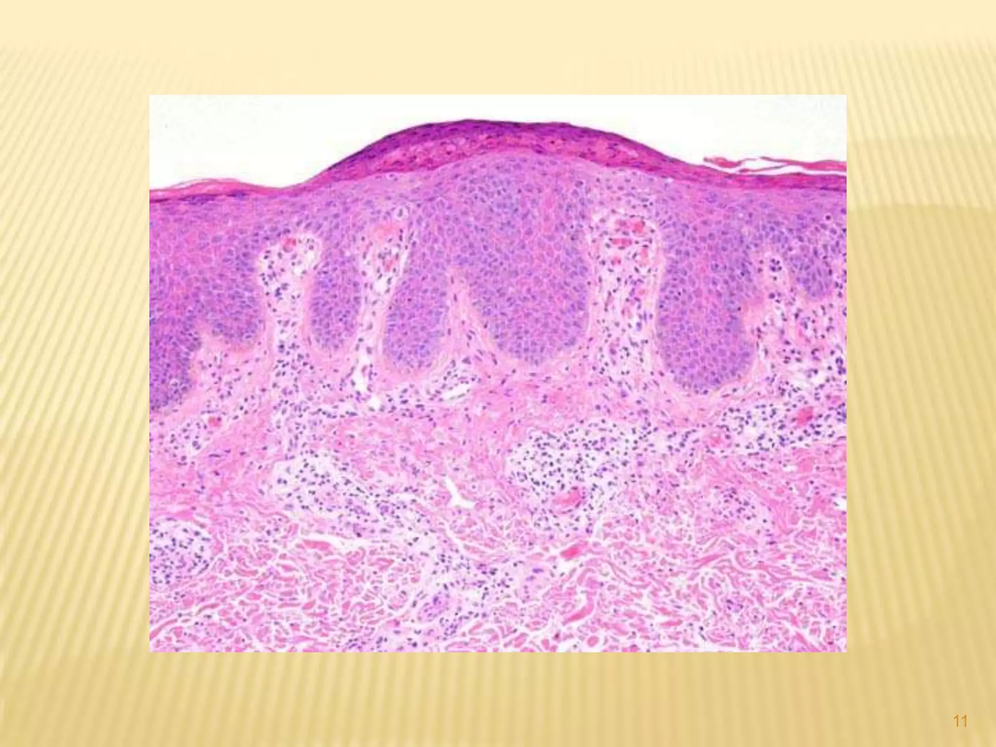 Chronic actinic dermatitis | PPTX
