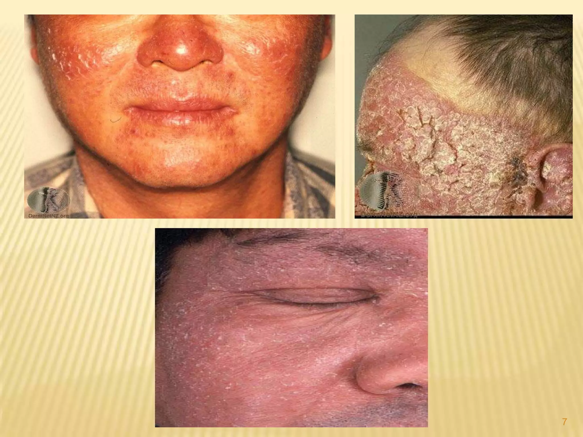 Chronic actinic dermatitis | PPTX