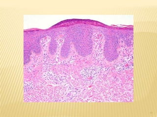 Chronic Actinic Dermatitis