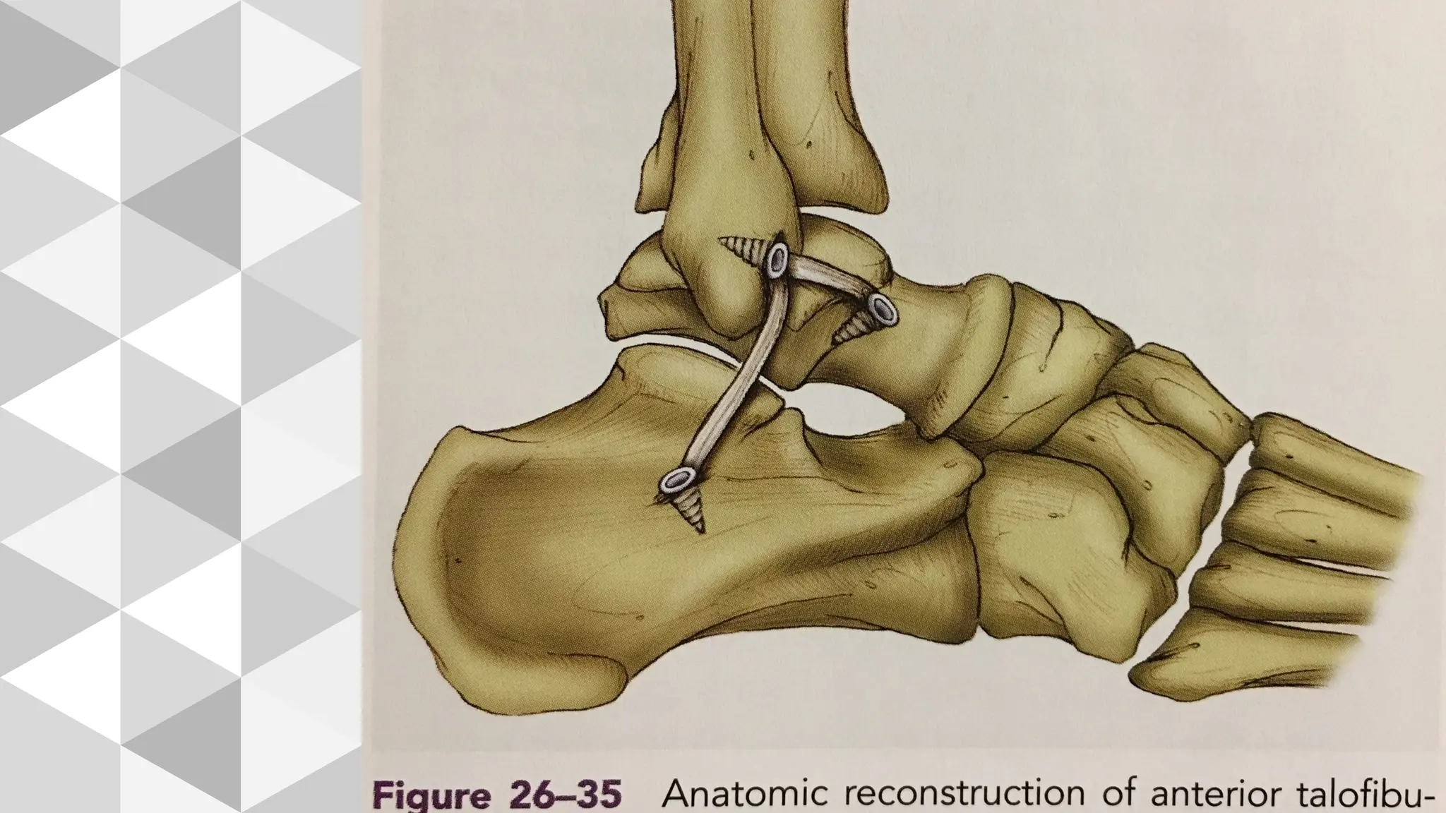 Chronic ankle instability training course .pptx