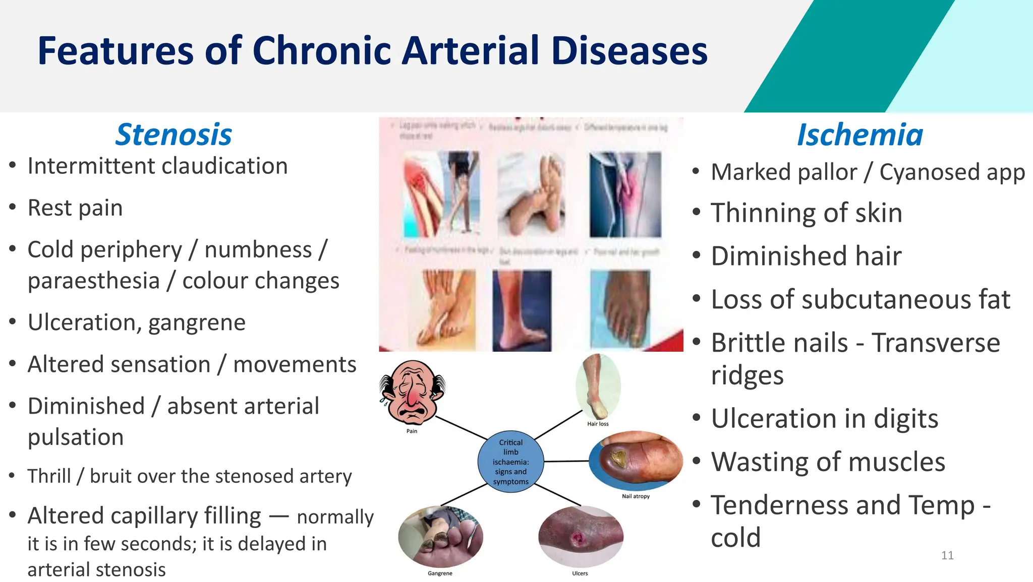 Chronic Arterial Diseases - Chronic Limb Ischemia | PDF
