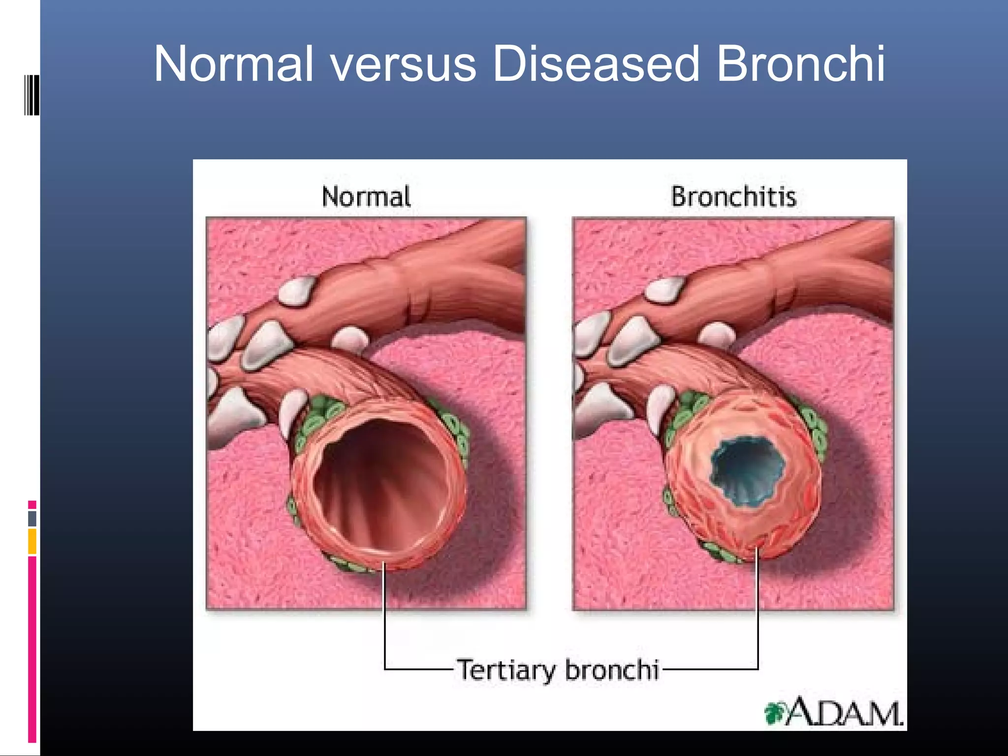 Chronic Bronchitis | PPT