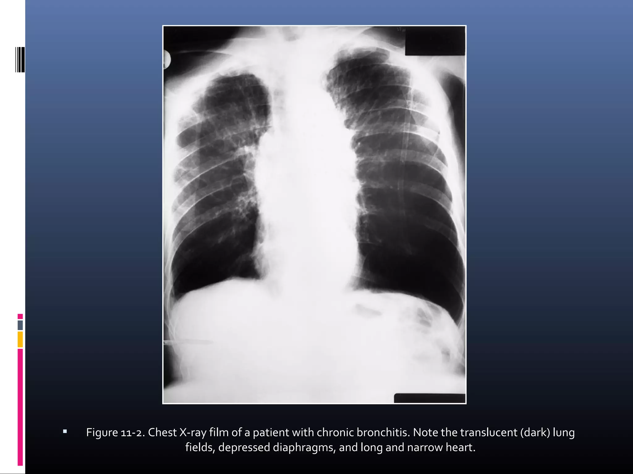 Chronic Bronchitis | PPT