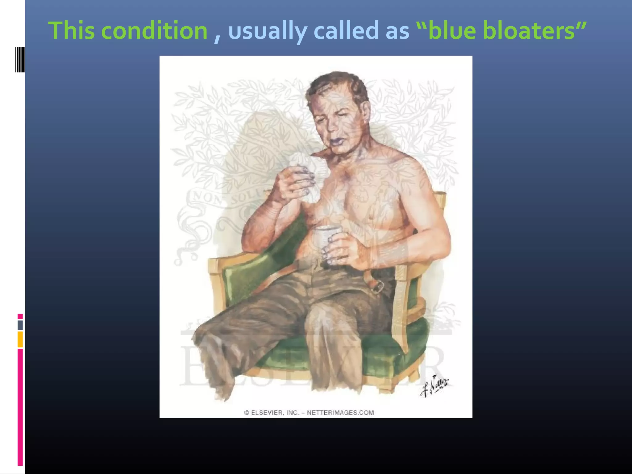 Chronic Bronchitis | PPT