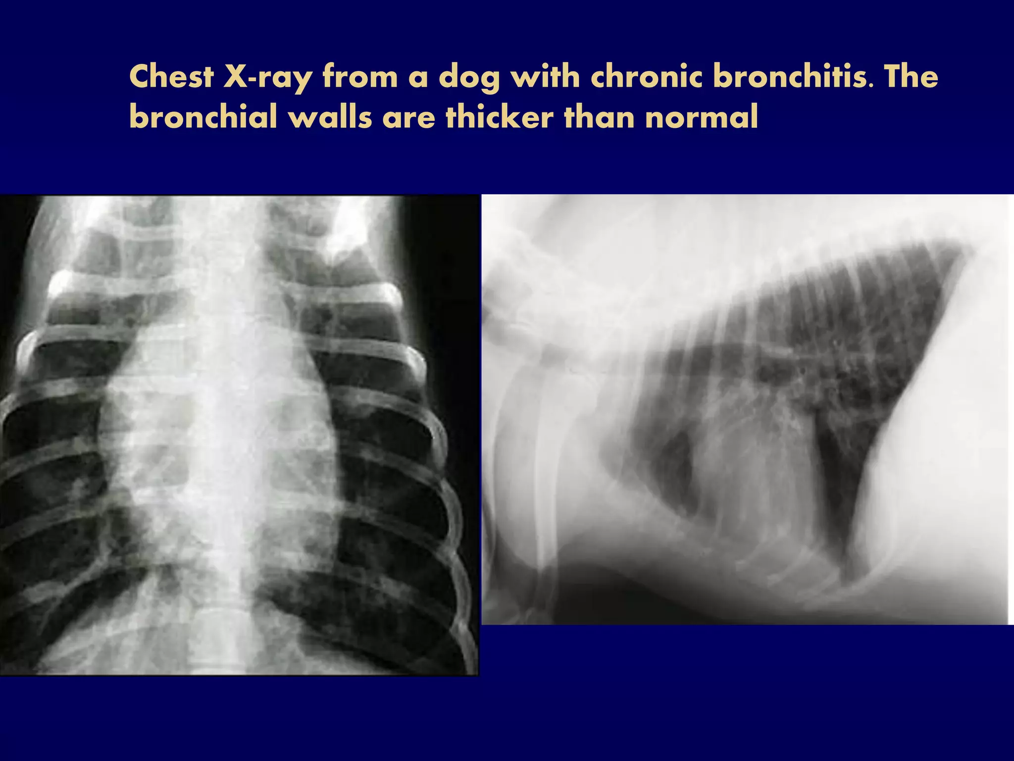 Chronic bronchitis | PDF