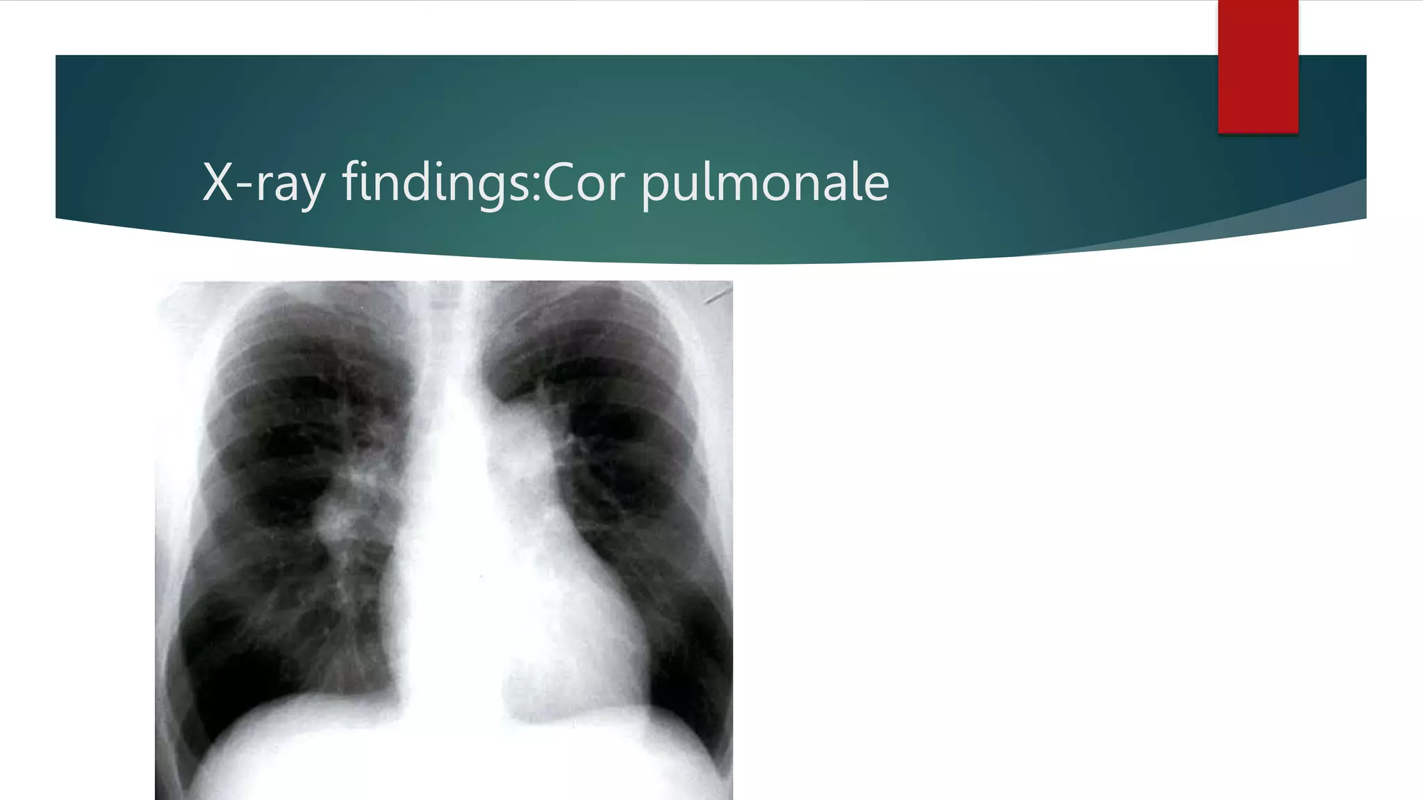 Chronic bronchitis Physio assessment.pptx