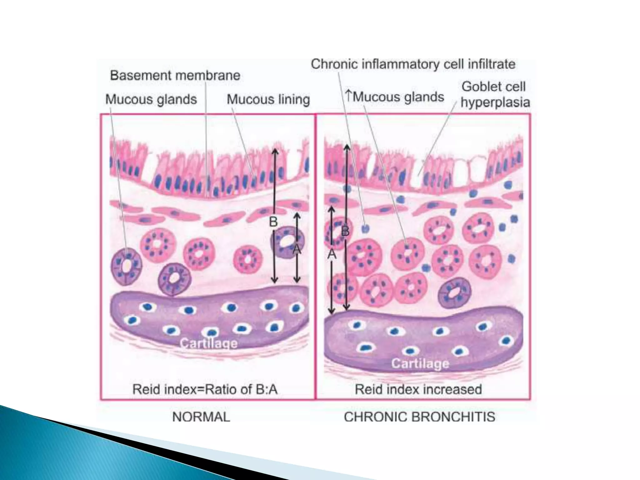 Chronic Bronchitis.pptx