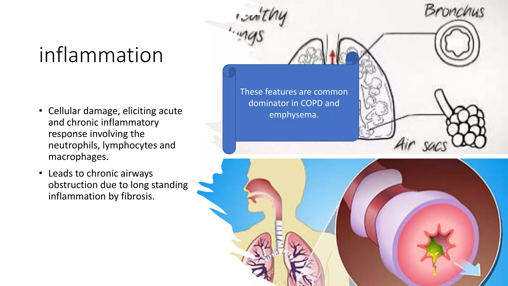 Chronic bronchitis(COPD).pptx