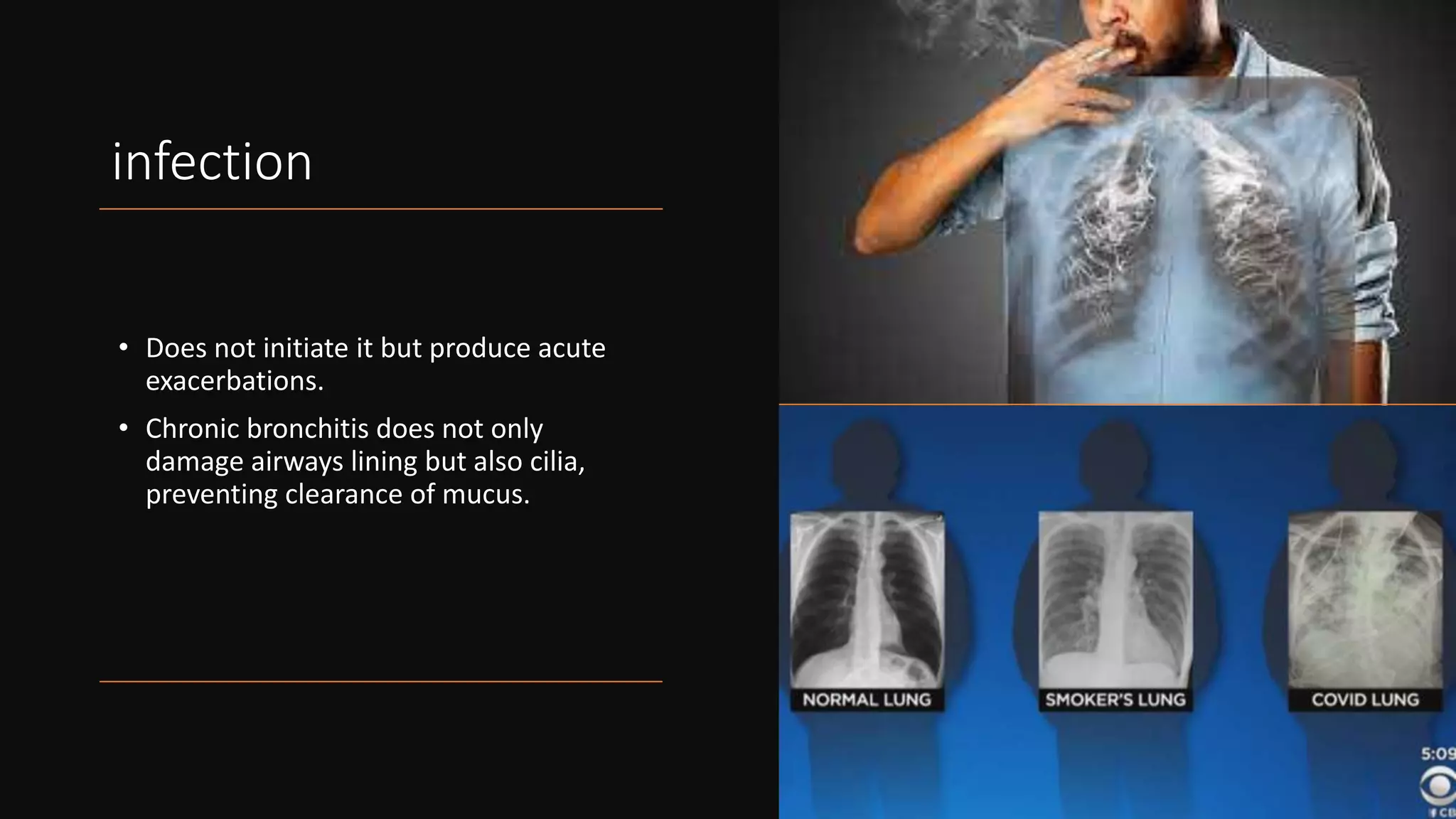 Chronic bronchitis(COPD).pptx