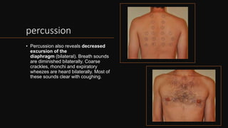 Chronic bronchitis(COPD).pptx