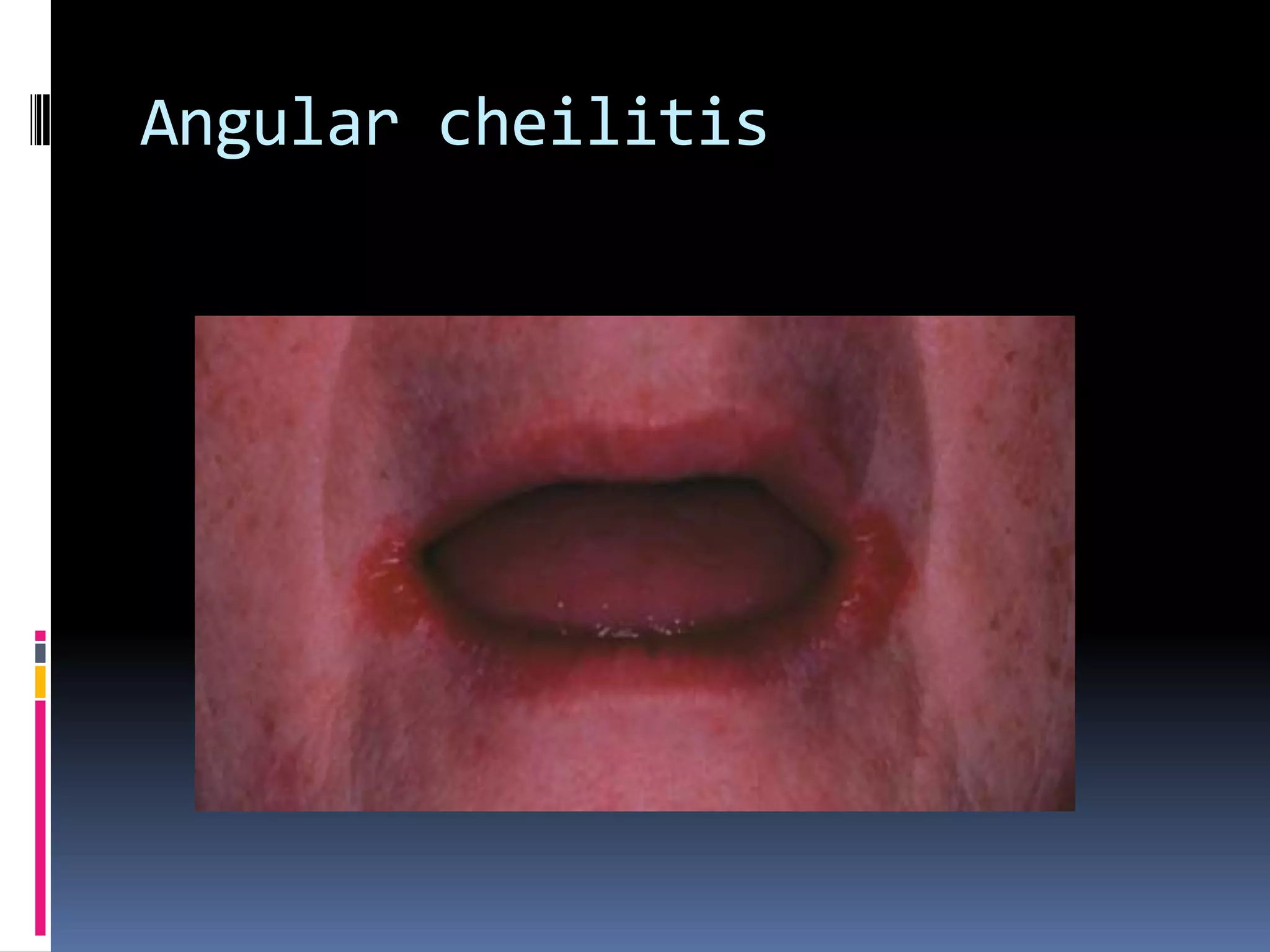 Chronic candidiasis | PPTX