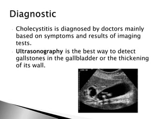 chroniccholecystitis-120811101403-phpapp01.pptx