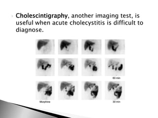 Chronic cholecystitis | PPTX