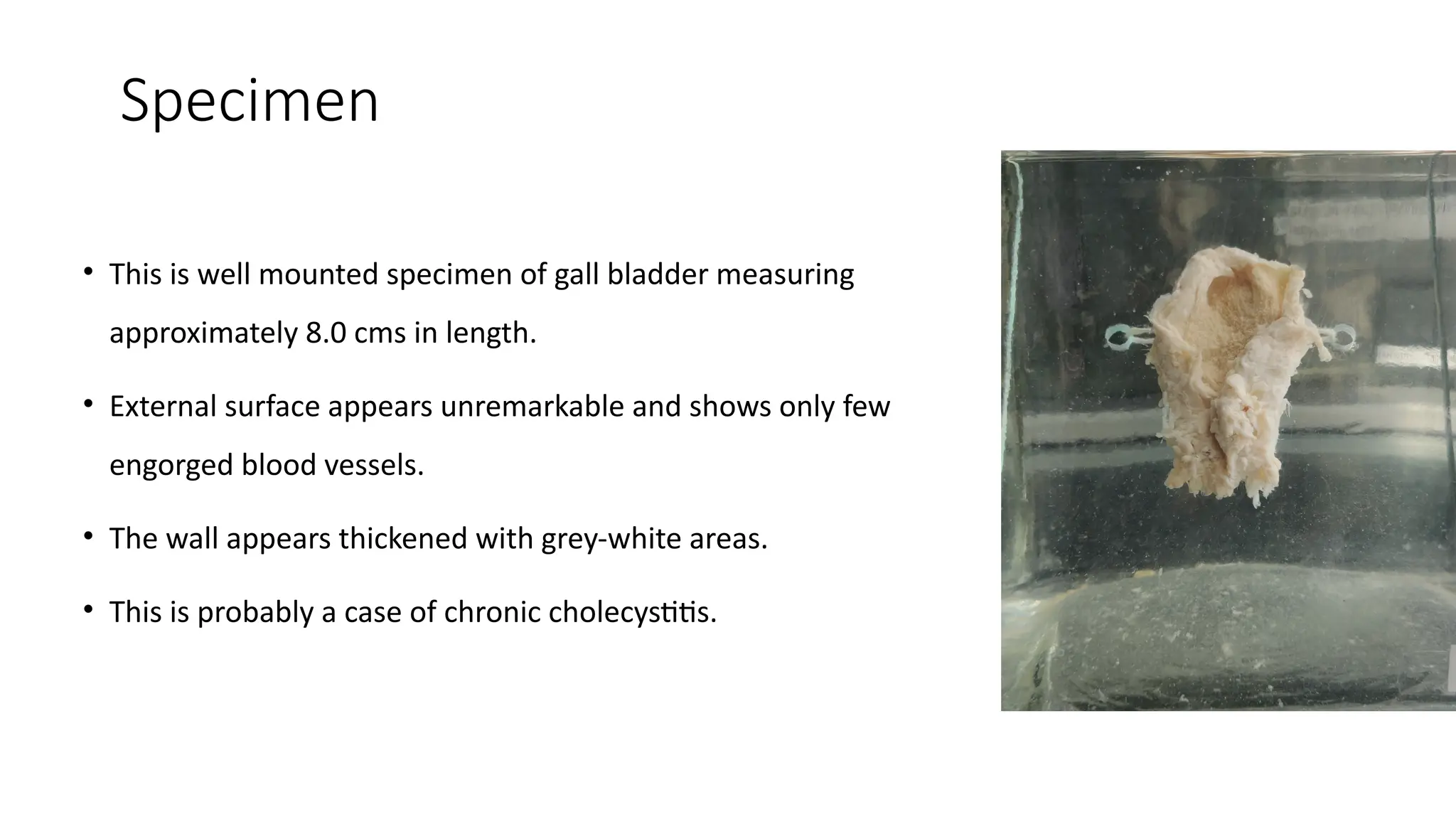 Chronic cholecystitis and inflammation for mbbs students | PPTX