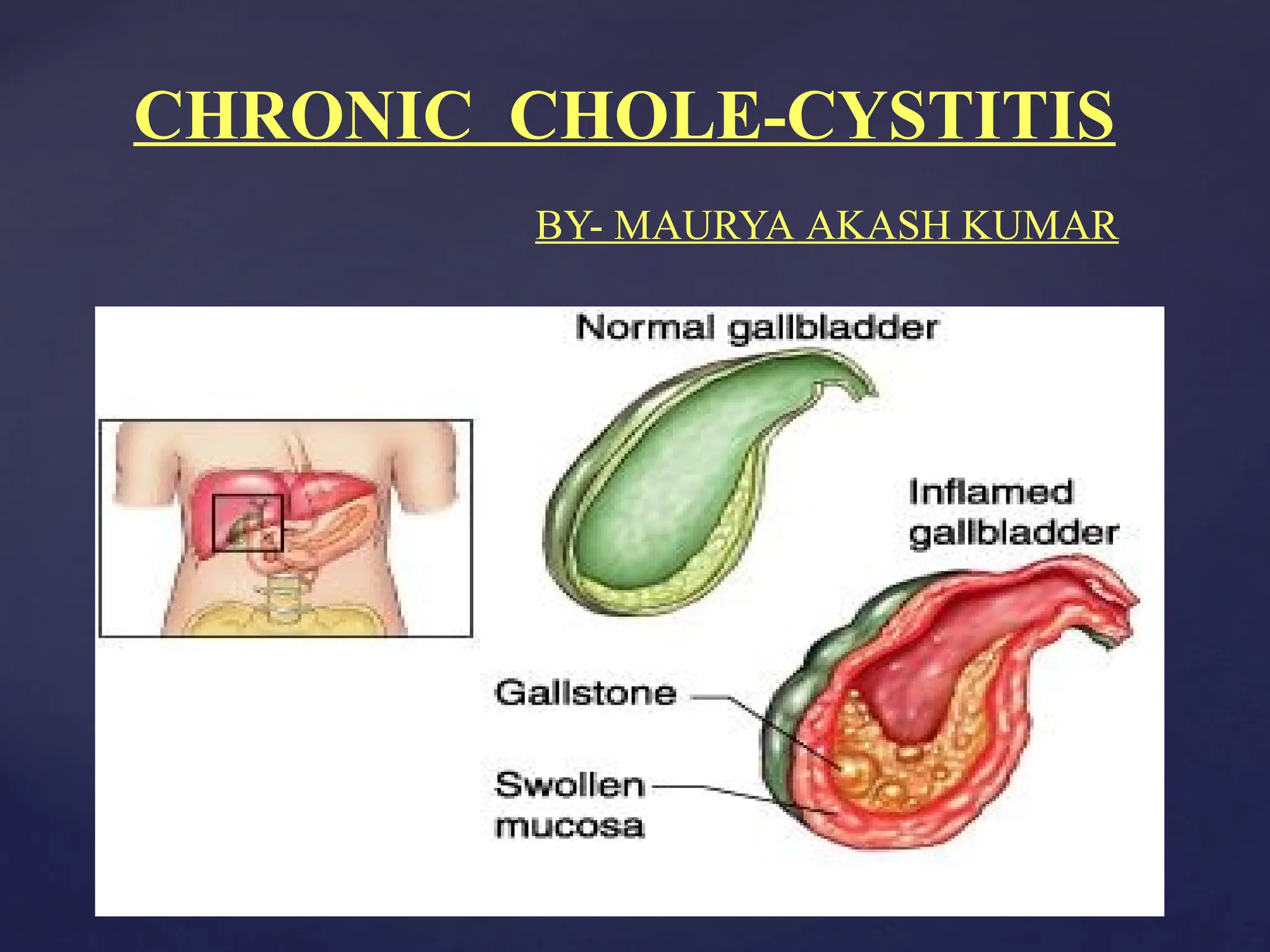 CHRONIC CHOLECYSTITIS AND ITS MANAGEMENT | PPTX