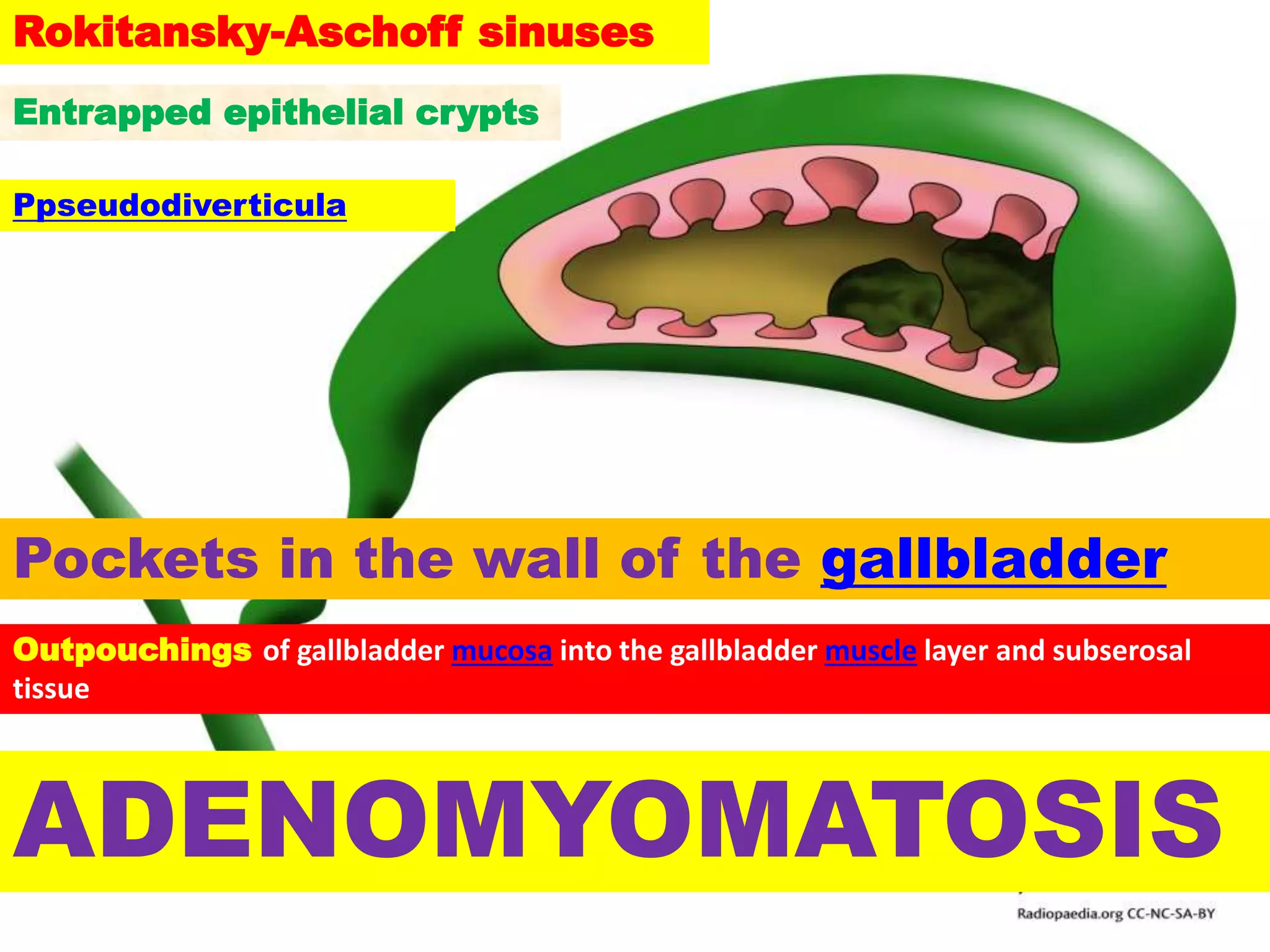Chronic cholecystitis practical | PPTX