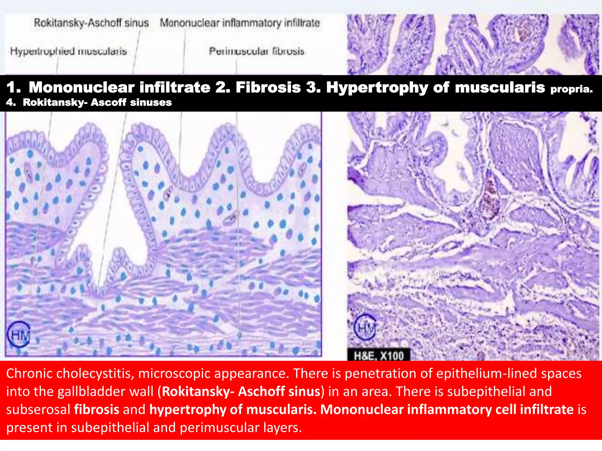 Chronic cholecystitis practical | PPTX