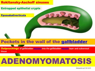 Chronic cholecystitis practical | PPTX