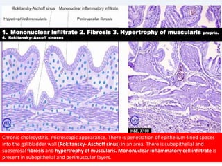Chronic cholecystitis practical | PPTX