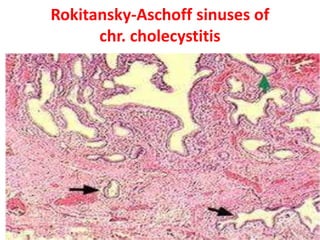 Chronic cholecystitis practical | PPTX