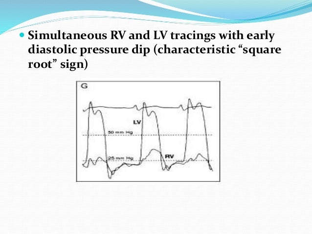 Chronic constrictive pericarditis