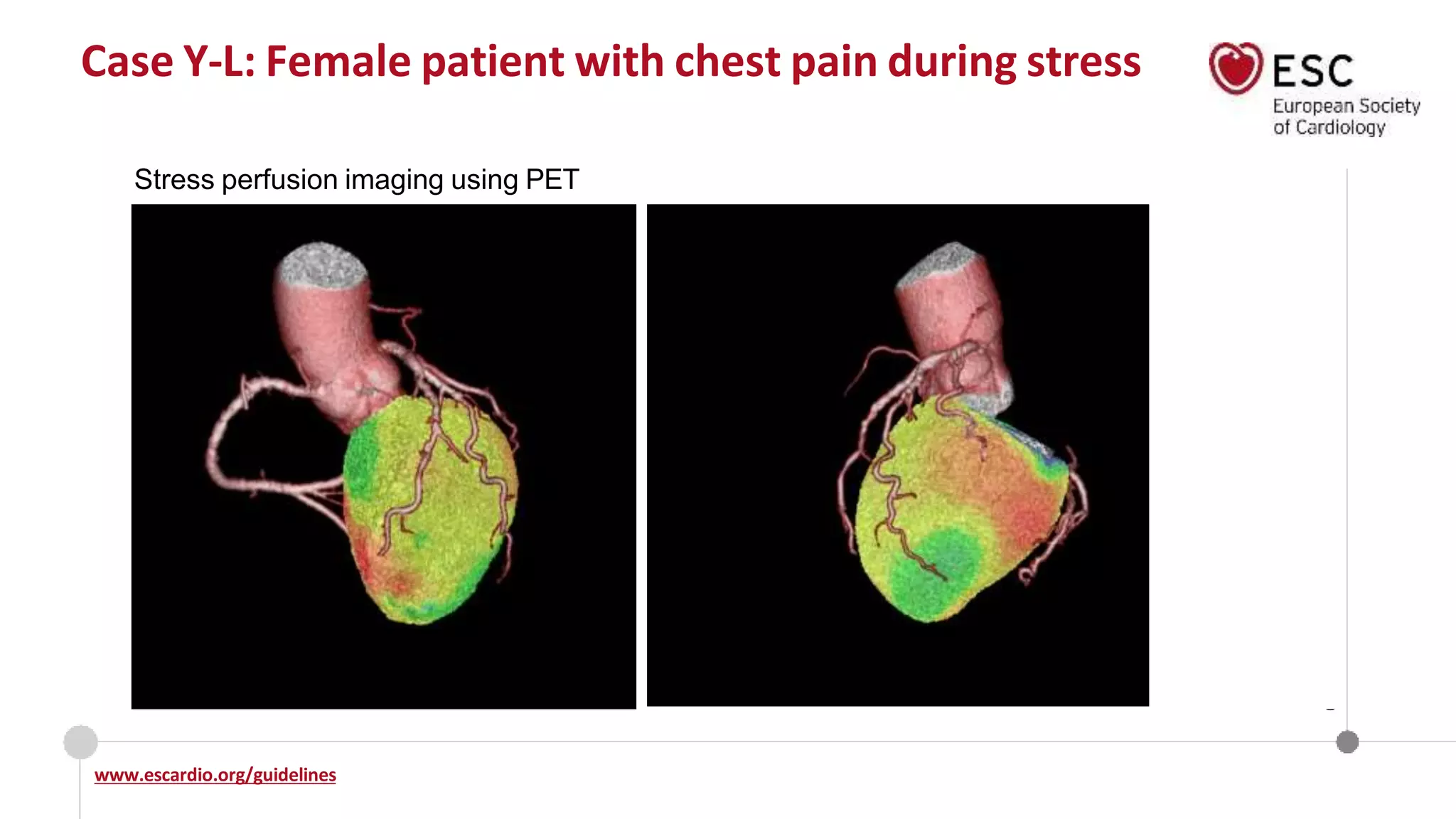 Chronic Coronary Syndrome ESC 2019.pptx