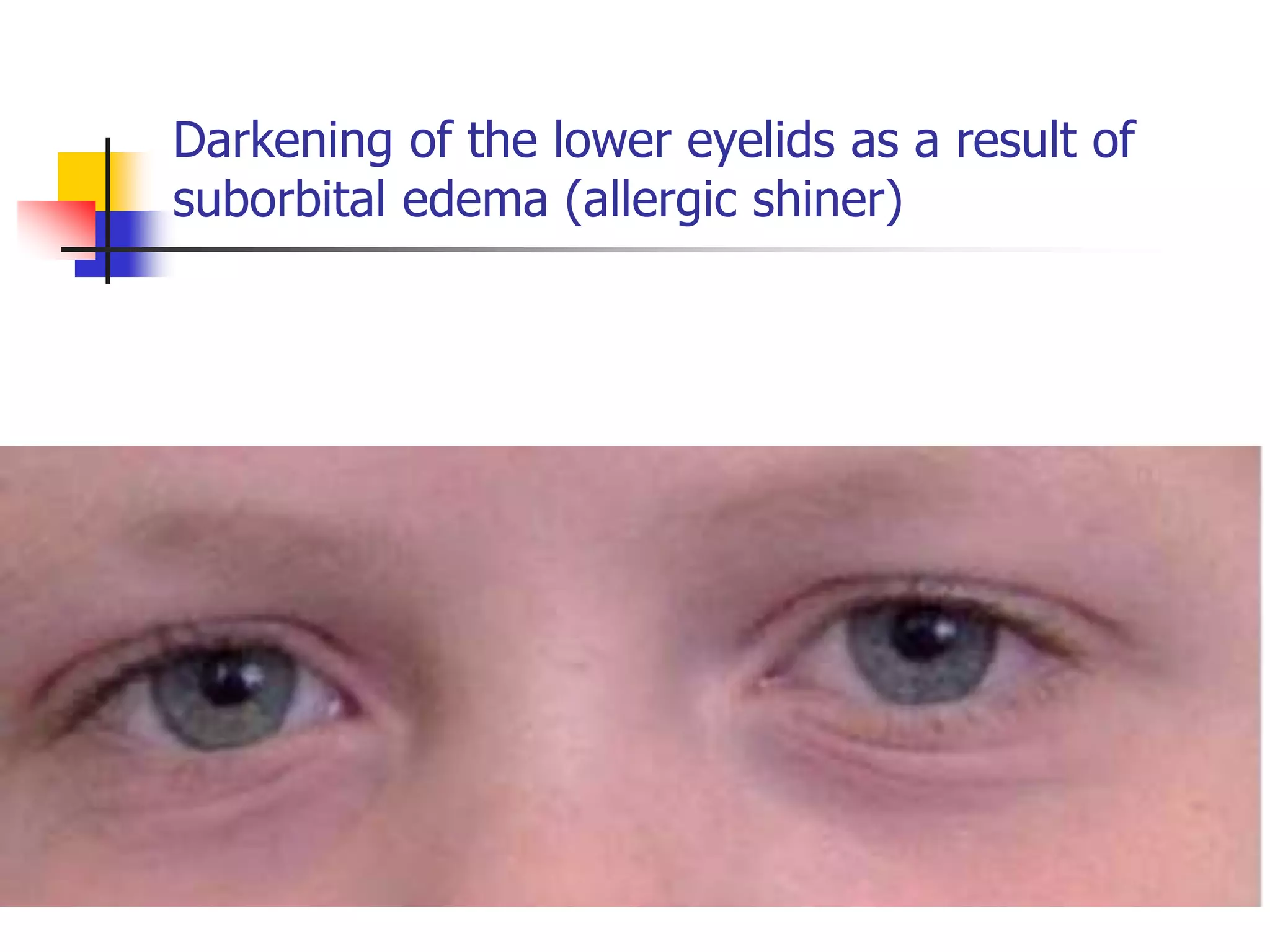 Chronic cough jan 2020 | PPT