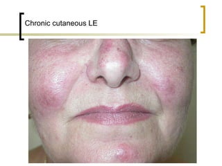 Chronic Cutaneous Lupus Erythematosus Difficult Management | PPT