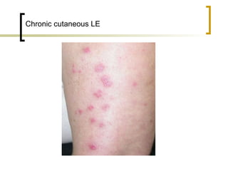 Chronic Cutaneous Lupus Erythematosus Difficult Management | PPT