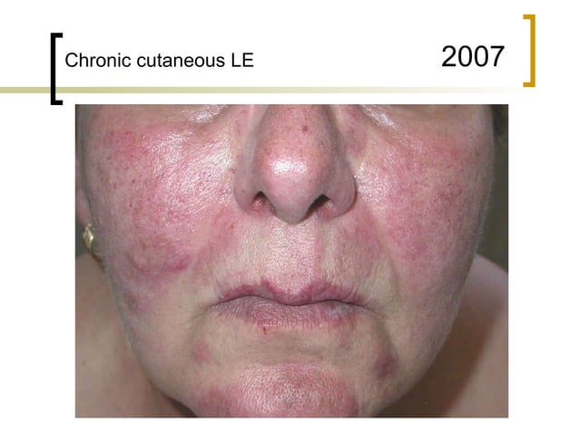 Chronic Cutaneous Lupus Erythematosus Difficult Management | PPT