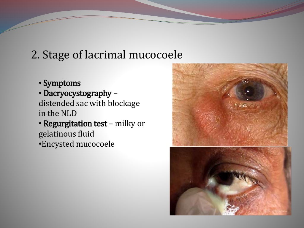 Chronic dacryocystitis