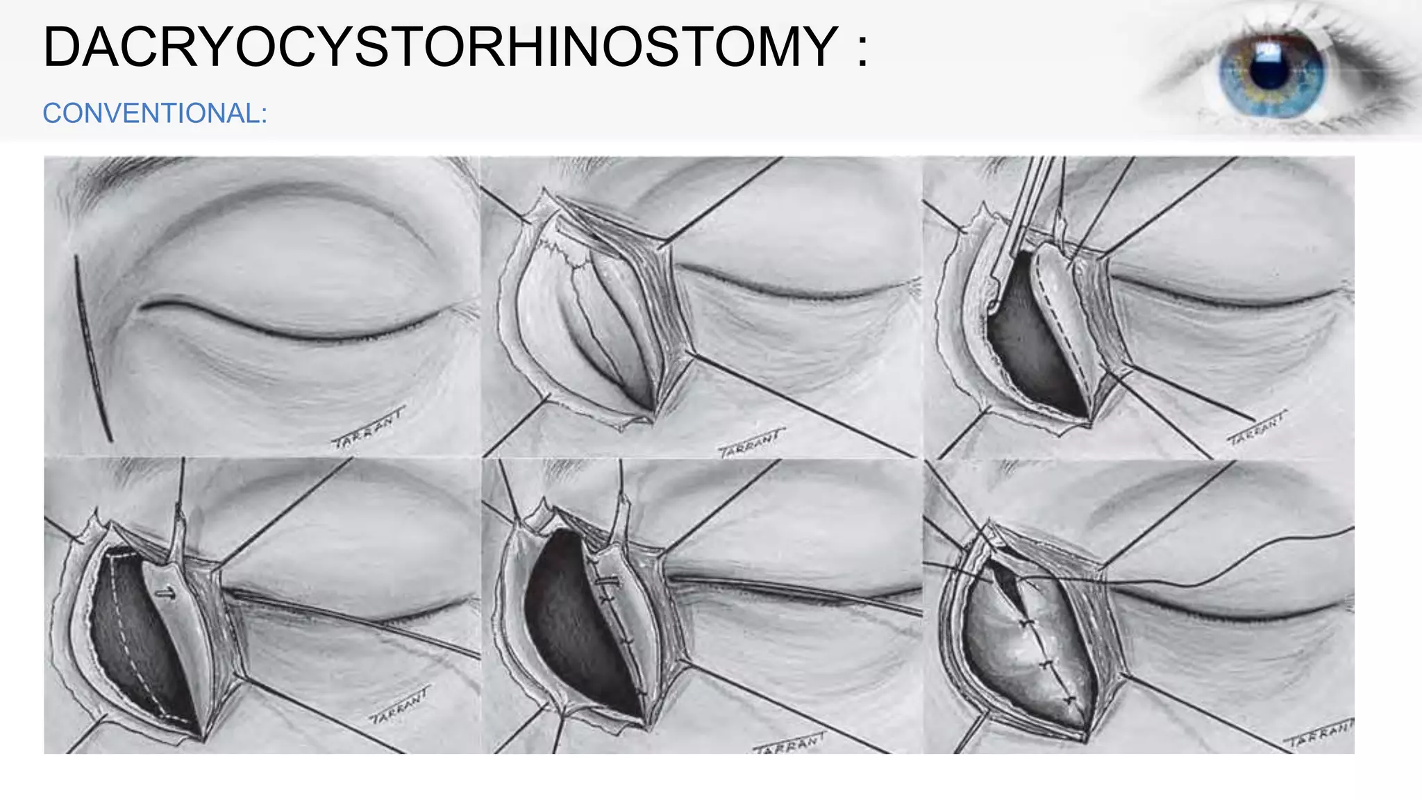 CHRONIC DACRYOCYSTITIS.pptx