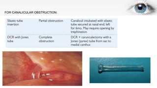 CHRONIC DACRYOCYSTITIS.pptx