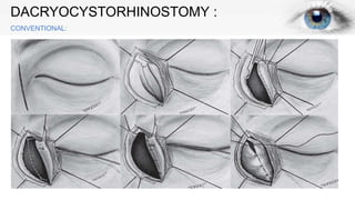 CHRONIC DACRYOCYSTITIS.pptx