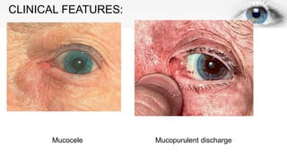 CHRONIC DACRYOCYSTITIS.pptx