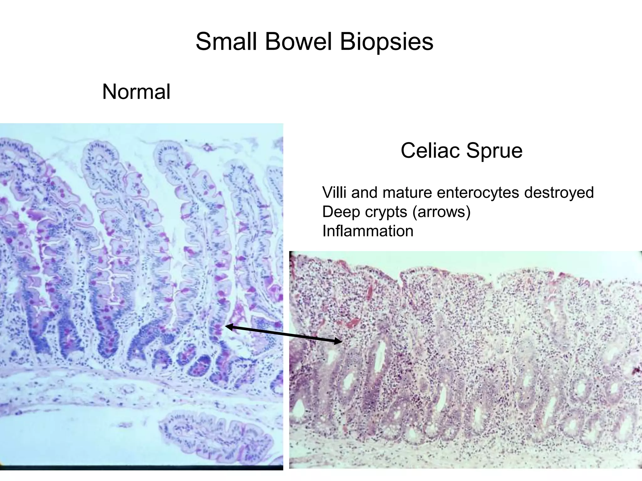 Chronic diarhea and malabsorption | PPT