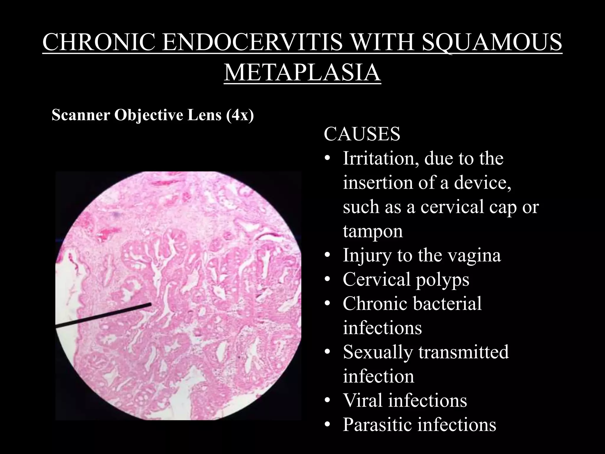 Chronic endocervitis with squamous metaplasia | PPTX