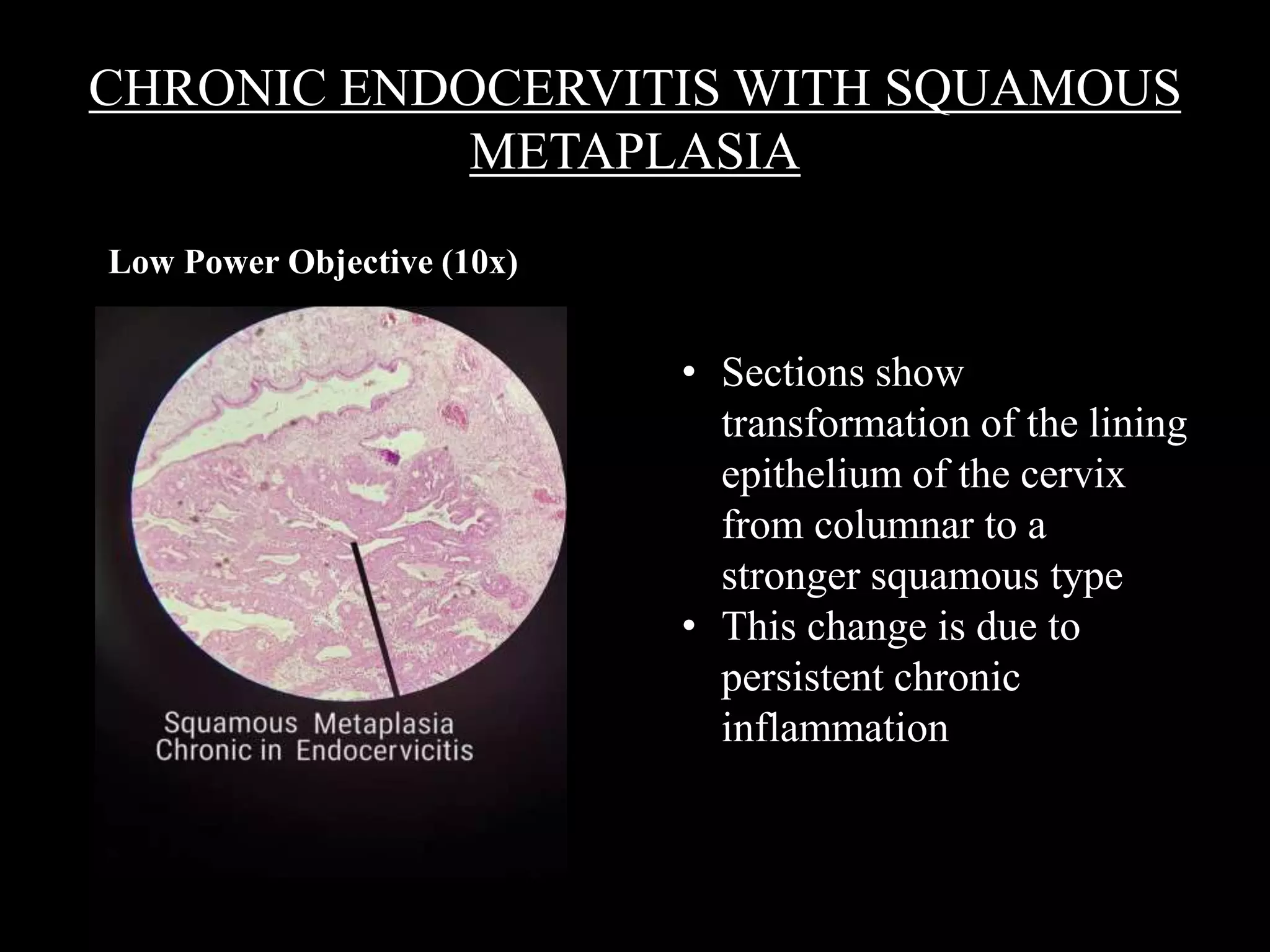 Chronic endocervitis with squamous metaplasia | PPTX