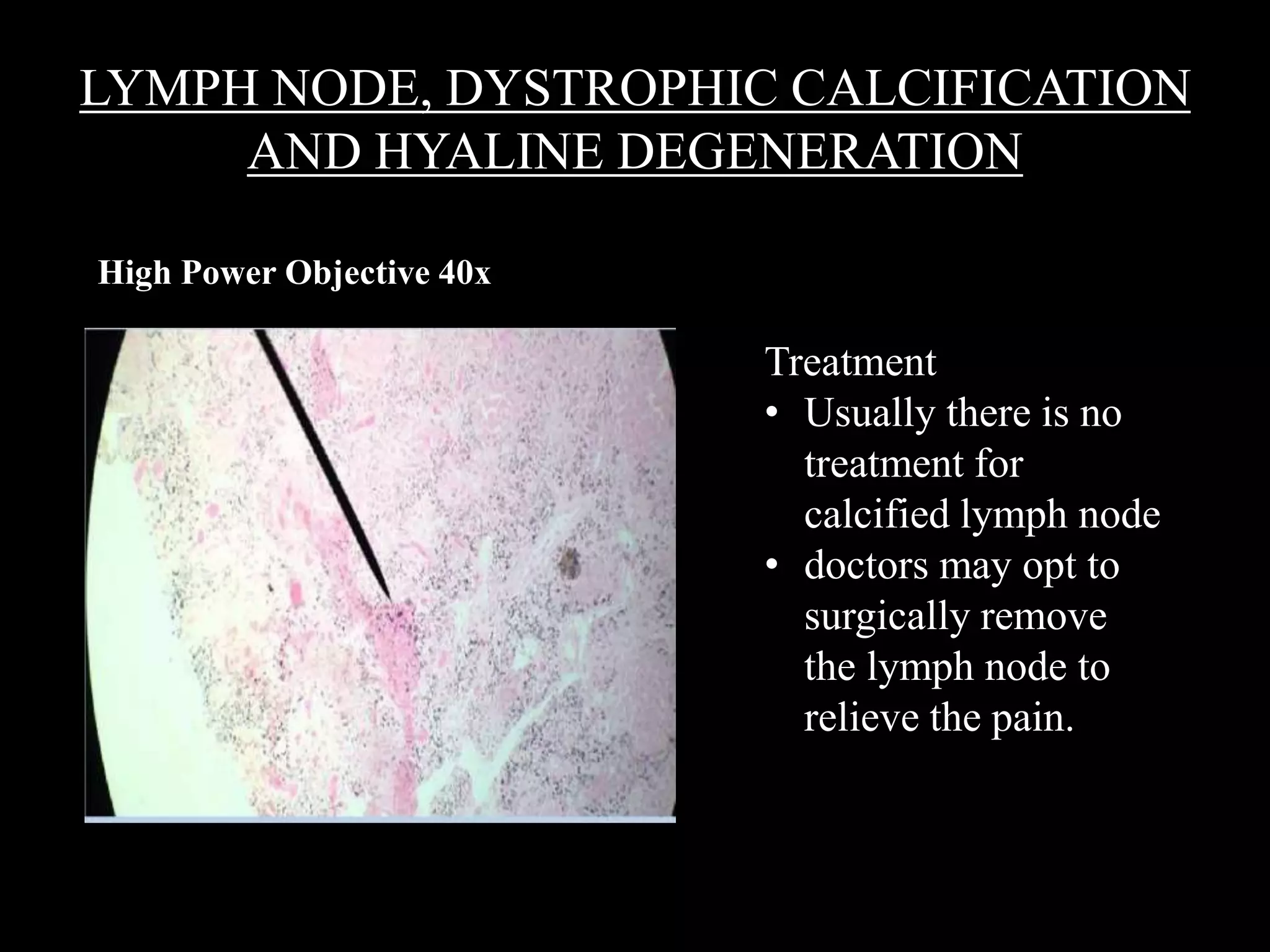 Chronic endocervitis with squamous metaplasia | PPTX