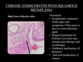 Chronic endocervitis with squamous metaplasia | PPTX