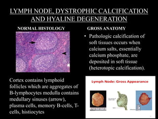 Chronic endocervitis with squamous metaplasia | PPTX