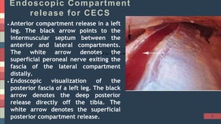 Chronic Exertional Compartment Syndrome | PPTX