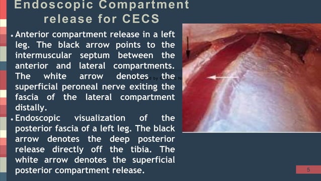 Chronic Exertional Compartment Syndrome | PPTX