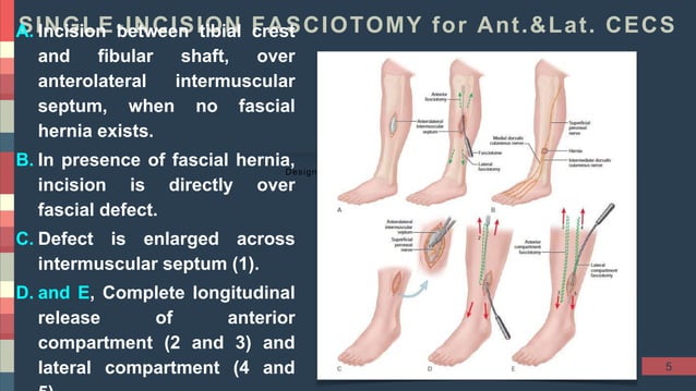 Chronic Exertional Compartment Syndrome