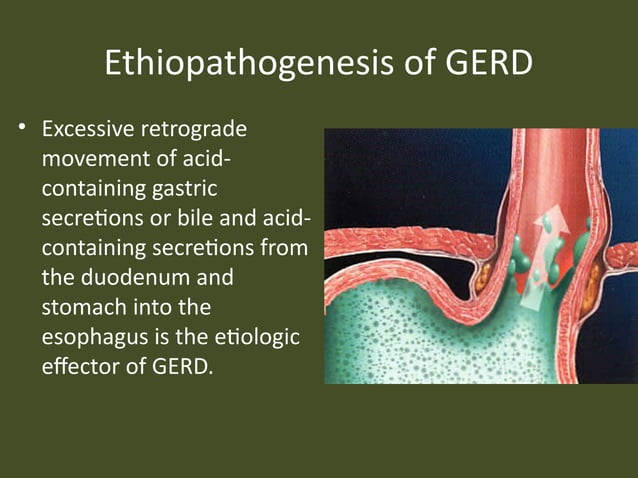 Chronic gastritis. GERD. Peptic ulcer (1).pptx