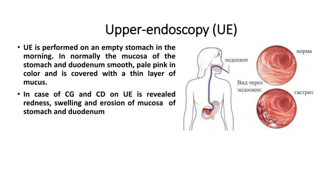 Chronic gastritis and duodenitis | PPTX