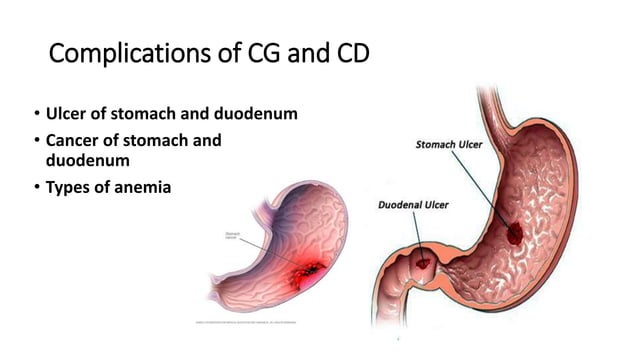 Chronic gastritis and duodenitis
