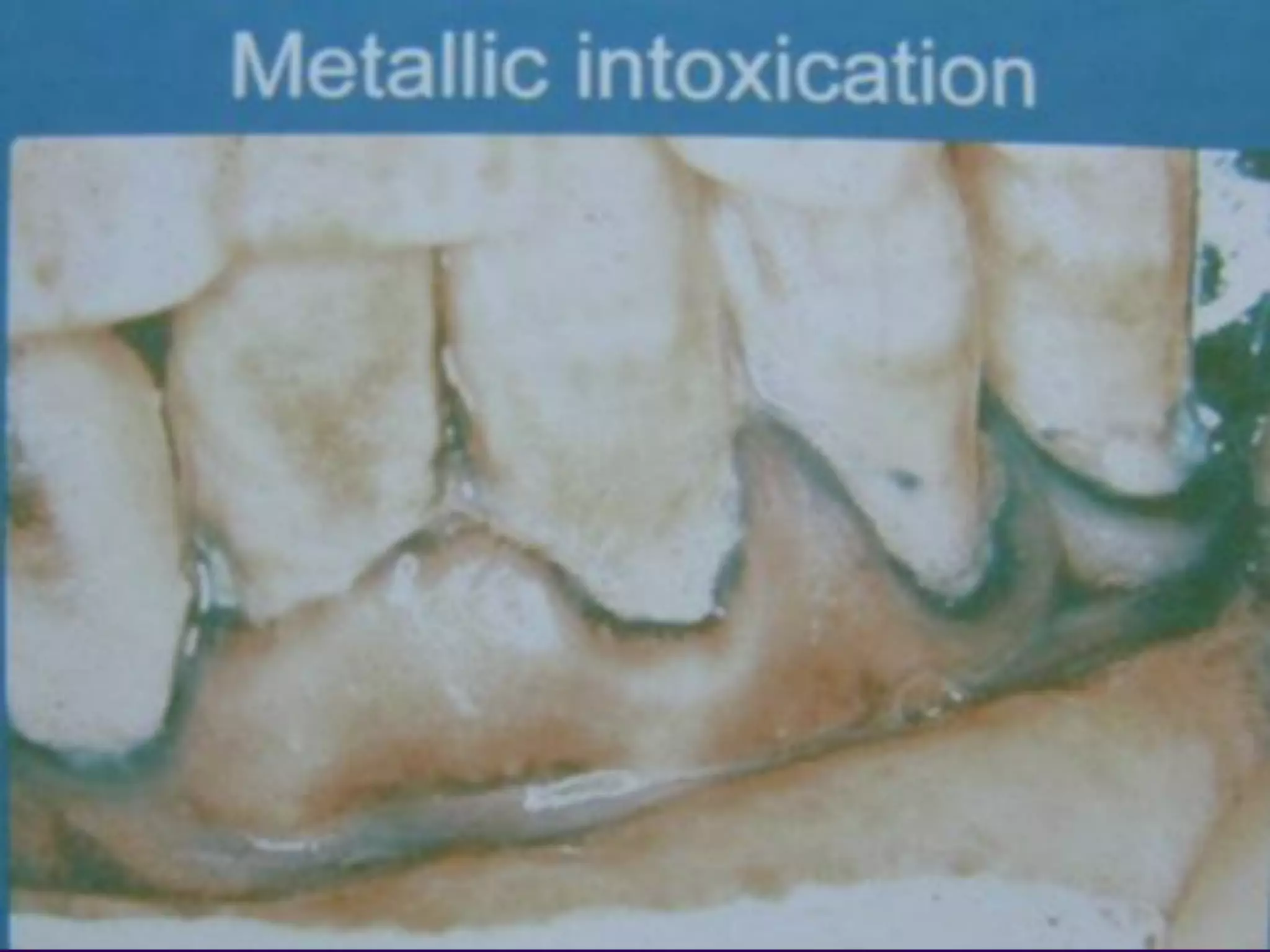 Chronic gingivitis | PDF | Dental Health | Diseases and Conditions