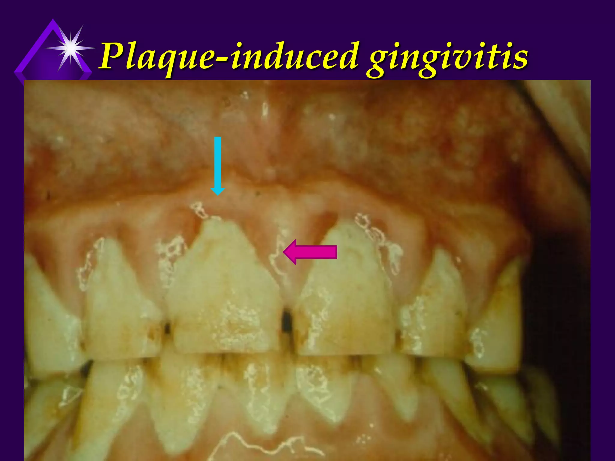 Chronic gingivitis | PDF